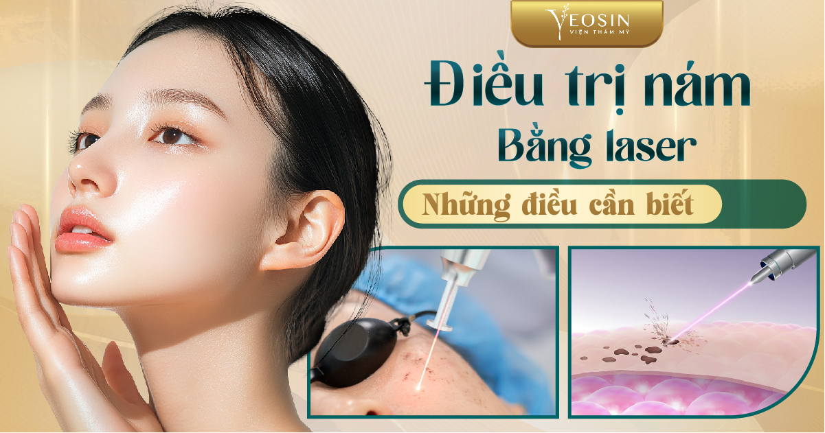 Điều trị nám bằng laser và những điều cần biết